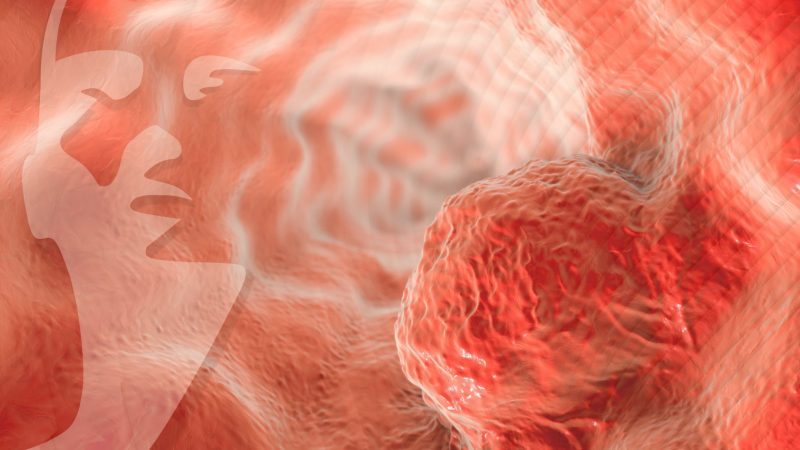 ¿Qué es un tumor benigno? | Cirujano oncólogo en Ciudad Juárez